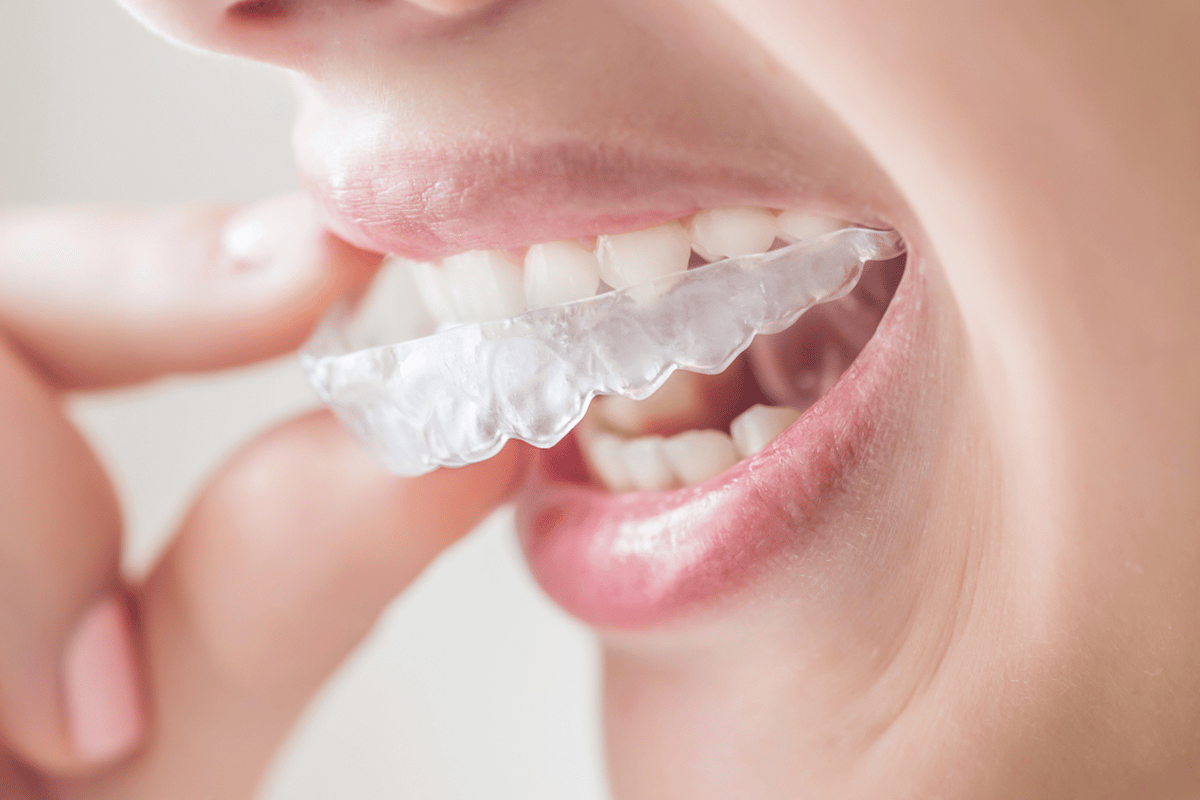 How Much Does Invisalign Cost in Sun City Center?